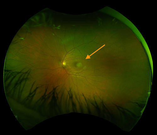 Case of visual impairment following inadvertent cosmetic laser exposure ...